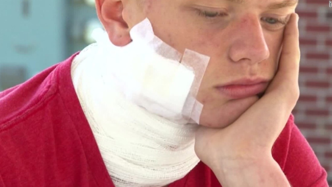 E-cigarette explodes, burns high school student - CNN Video