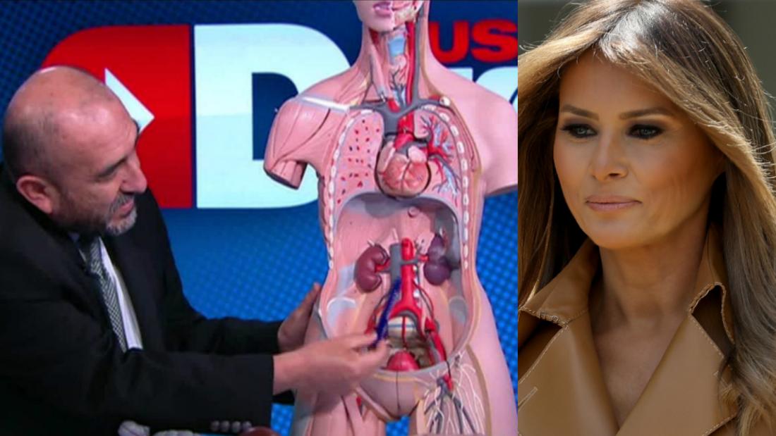 La Cirugía De Riñón De Melania Trump Un Doctor Explica Paso A Paso El